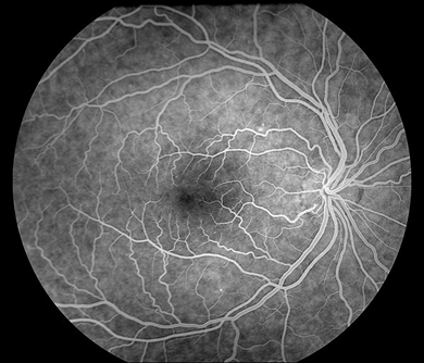Fluorescein Angiography | LA Retina Center